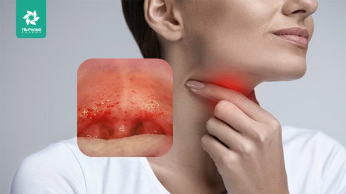 Viêm họng xung huyết có nguy hiểm không? Triệu chứng & Điều trị